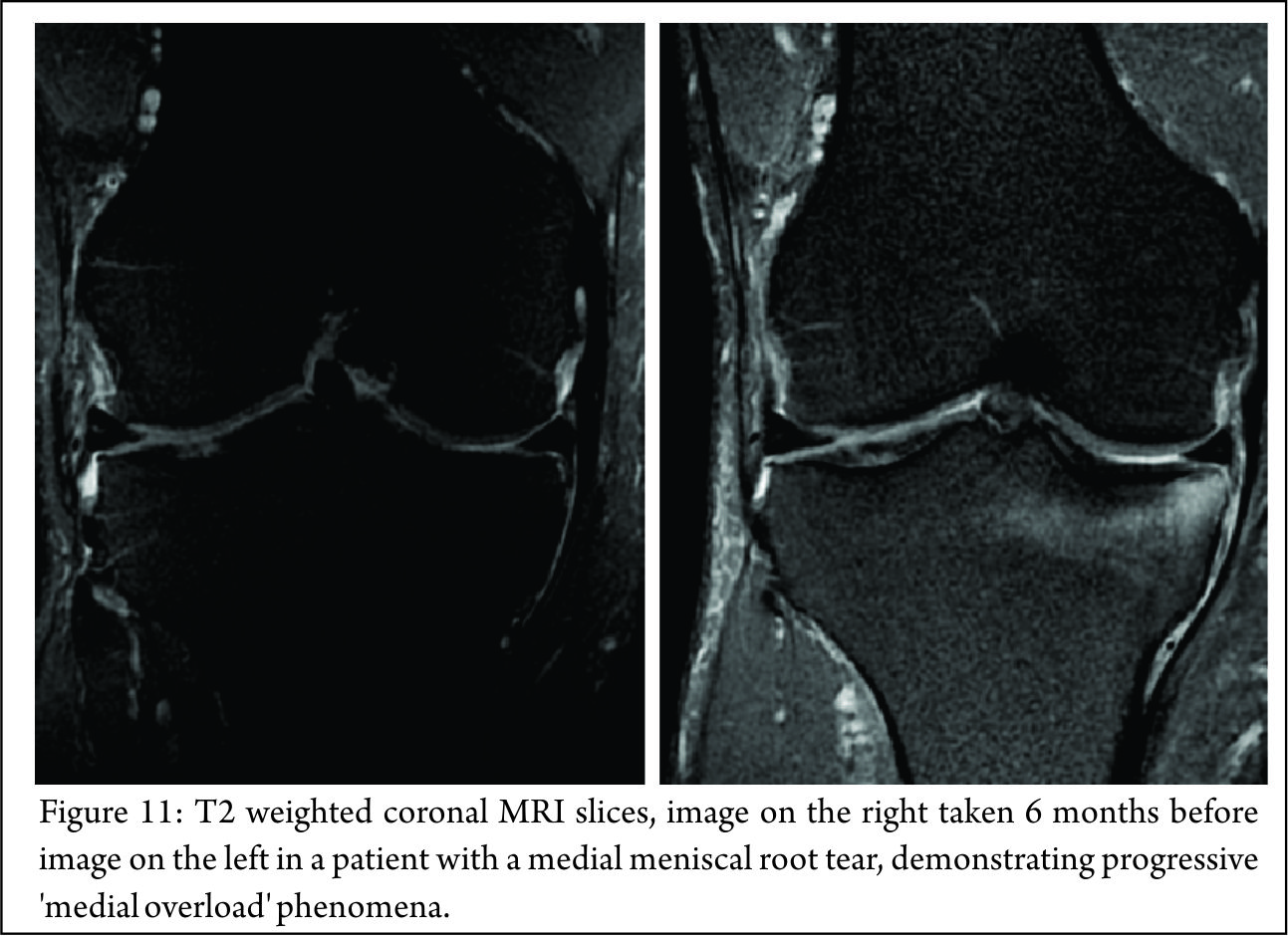 Asian Journal of Arthroscopy | Meniscal Root Tears: Current Concepts