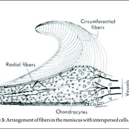 Asian Journal of Arthroscopy | Inside-Out Meniscus Repair – A Review