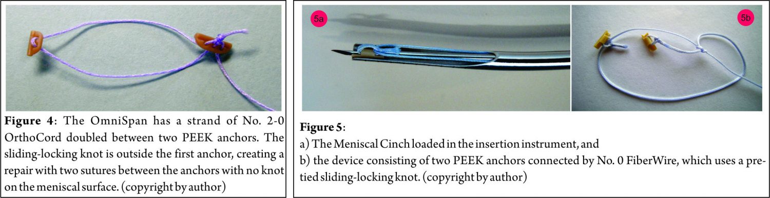 All-Inside Meniscus Repair | Asian Journal of Arthroscopy
