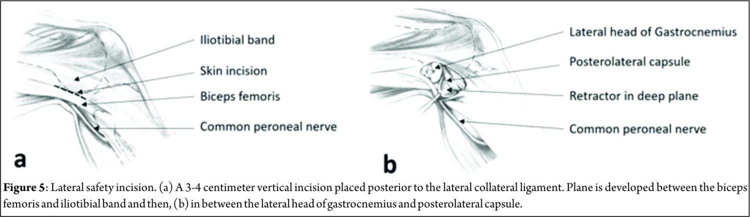 Asian Journal of Arthroscopy | Inside-Out Meniscus Repair – A Review